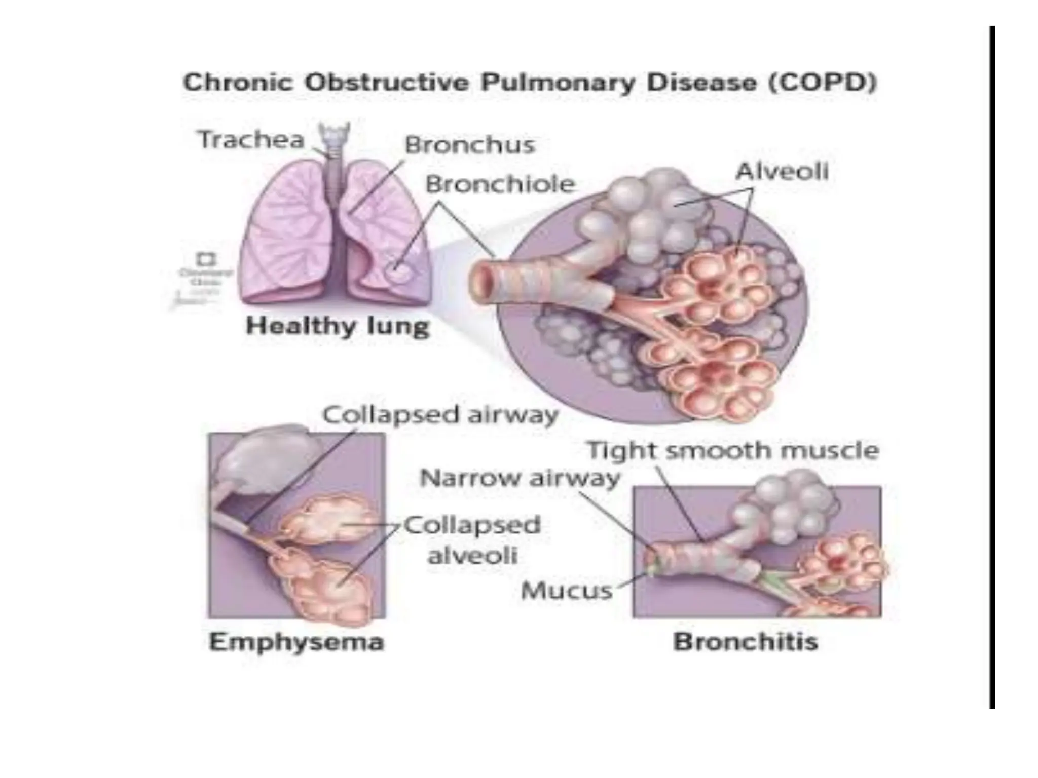 Chronic obstructive pulmonary disease case | PPTX