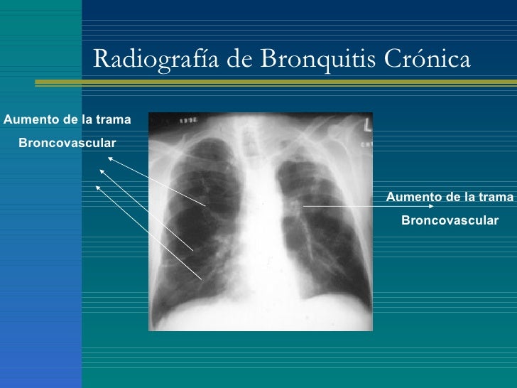 Copia de bronquitis cronica enfi y core