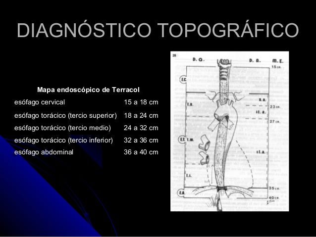 Copia de cancer de esófago dbc final