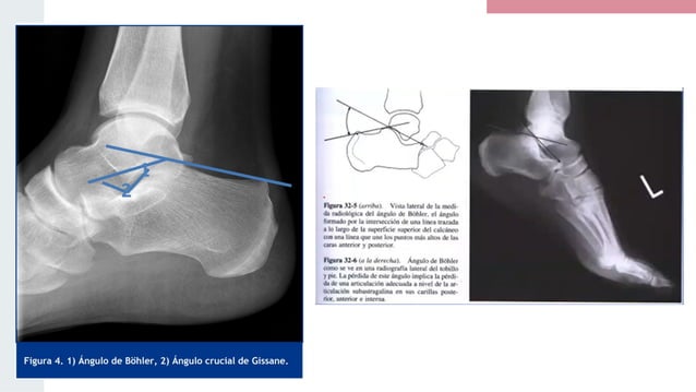 Fractura de retropié traumatología y ortopedia.pptx