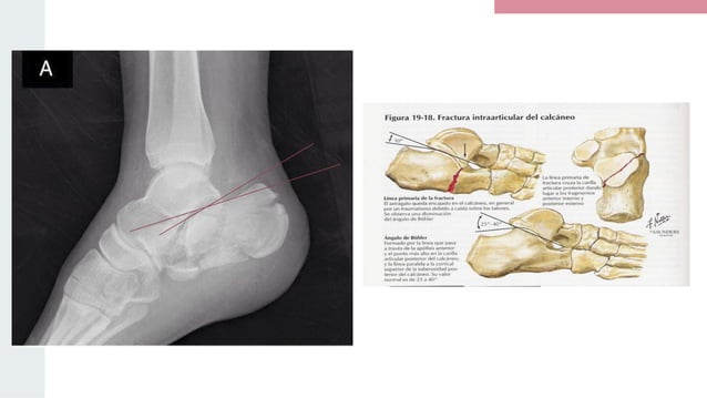 Fractura de retropié traumatología y ortopedia.pptx