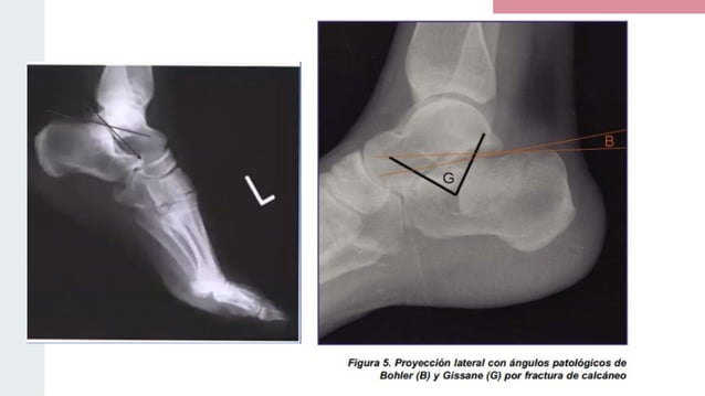 Fractura de retropié traumatología y ortopedia.pptx