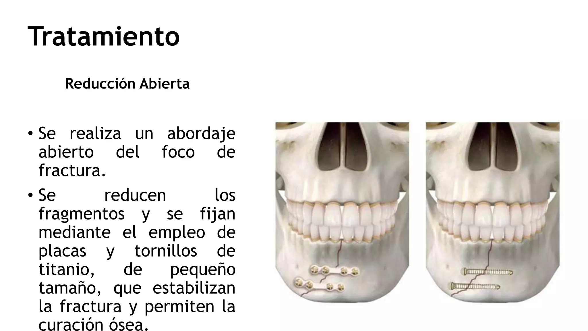 Fracturas de mandibula.pptx