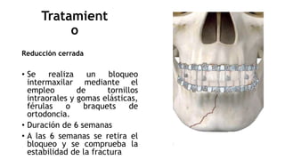 Fracturas de mandibula.pptx
