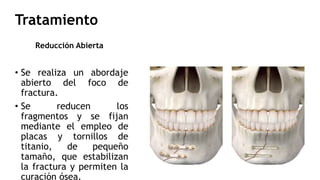 Fracturas de mandibula.pptx