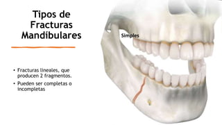 Fracturas de mandibula.pptx