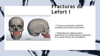 Fracturas de mandibula.pptx