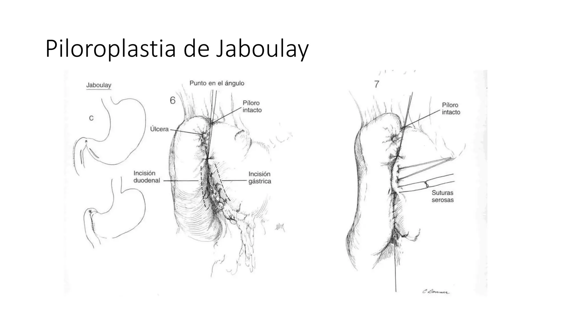gastrostomias y piloroplastias.pptx
