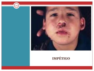 Infecciones de piel y partes blandas | PPSX