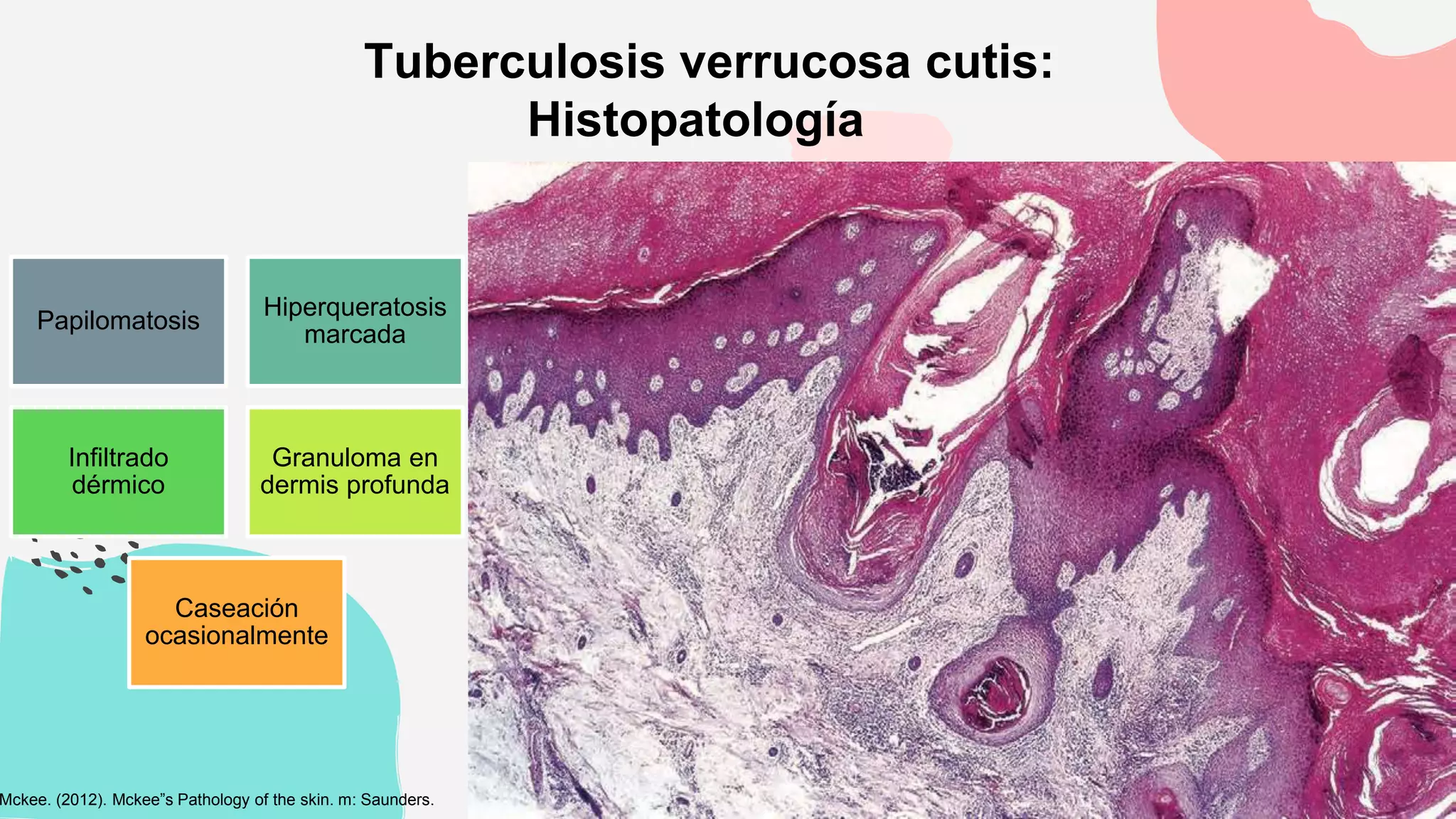 Tuberculosis cutanea