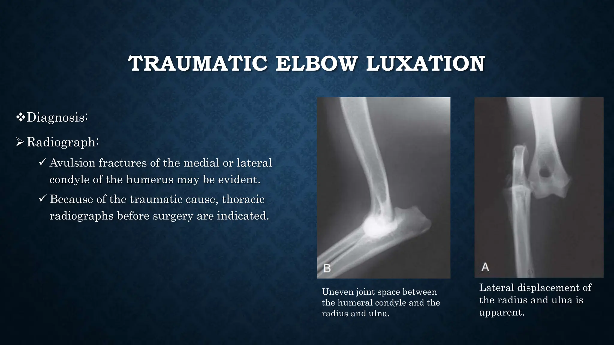 Copie de Elbow dislocation and dysplasia.pptx