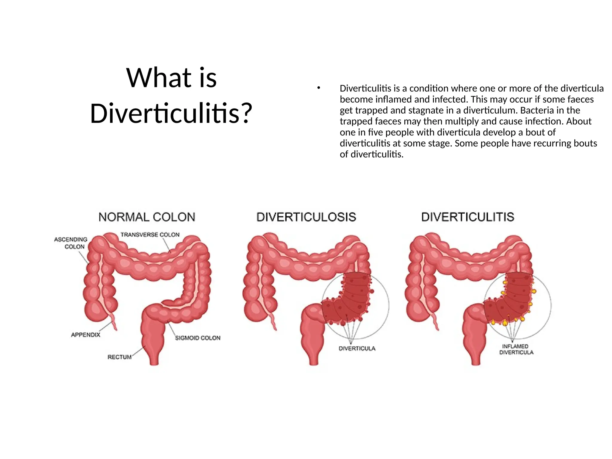 Coping with Diverticulitis of the Human Body | PPTX