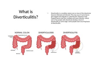 Coping with Diverticulitis of the Human Body | PPTX