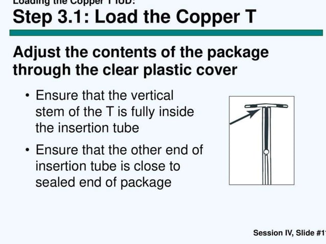 Copper T insertion | PPT