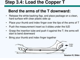 Copper T insertion | PPT