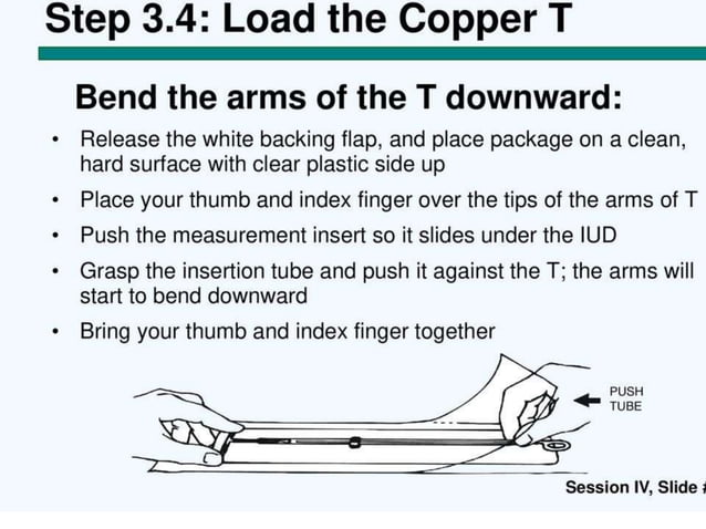 Copper T insertion | PPT
