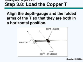 Copper T insertion | PPT