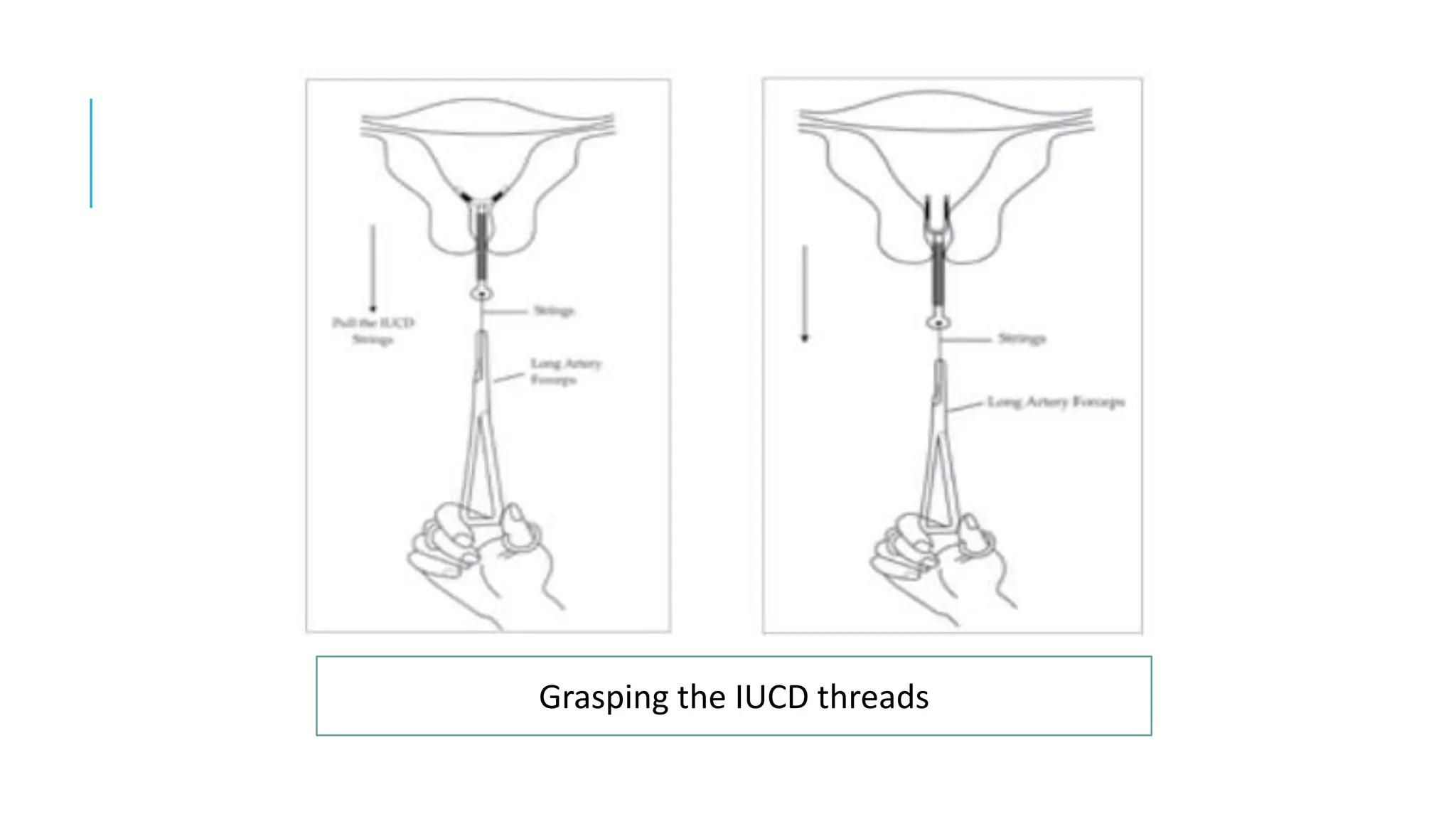 copper t presentation - insertion and removal.pptx