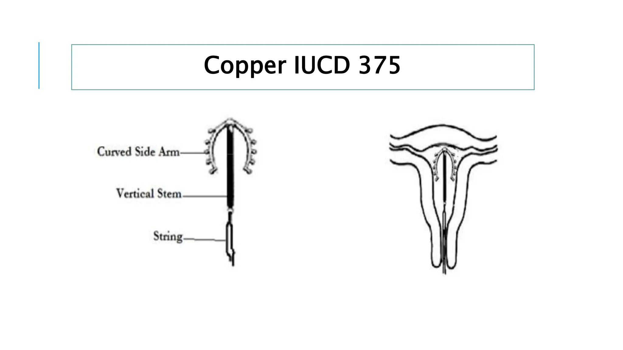 copper t presentation - insertion and removal.pptx | Pregnancy ...