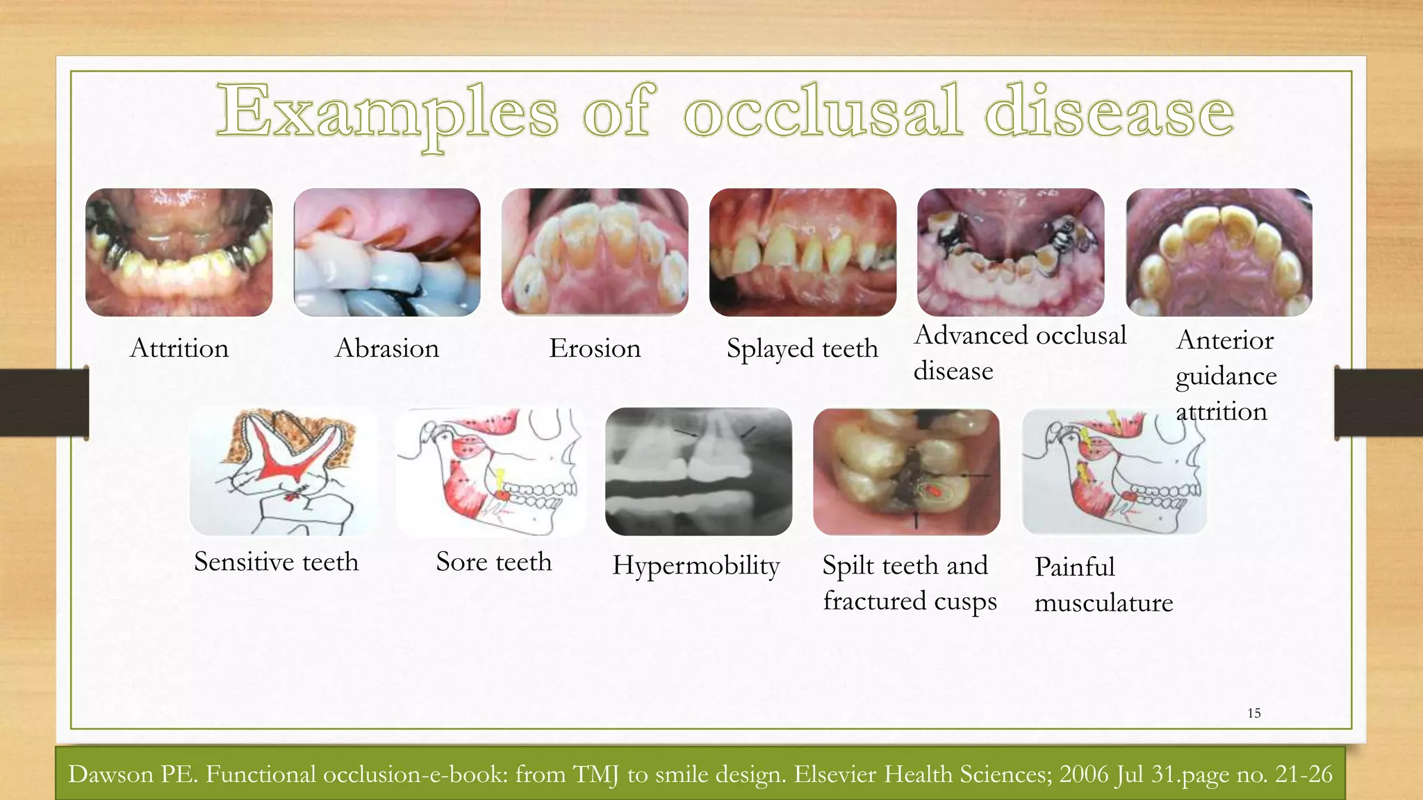 full mouth rehabilitation part 1 | PPTX
