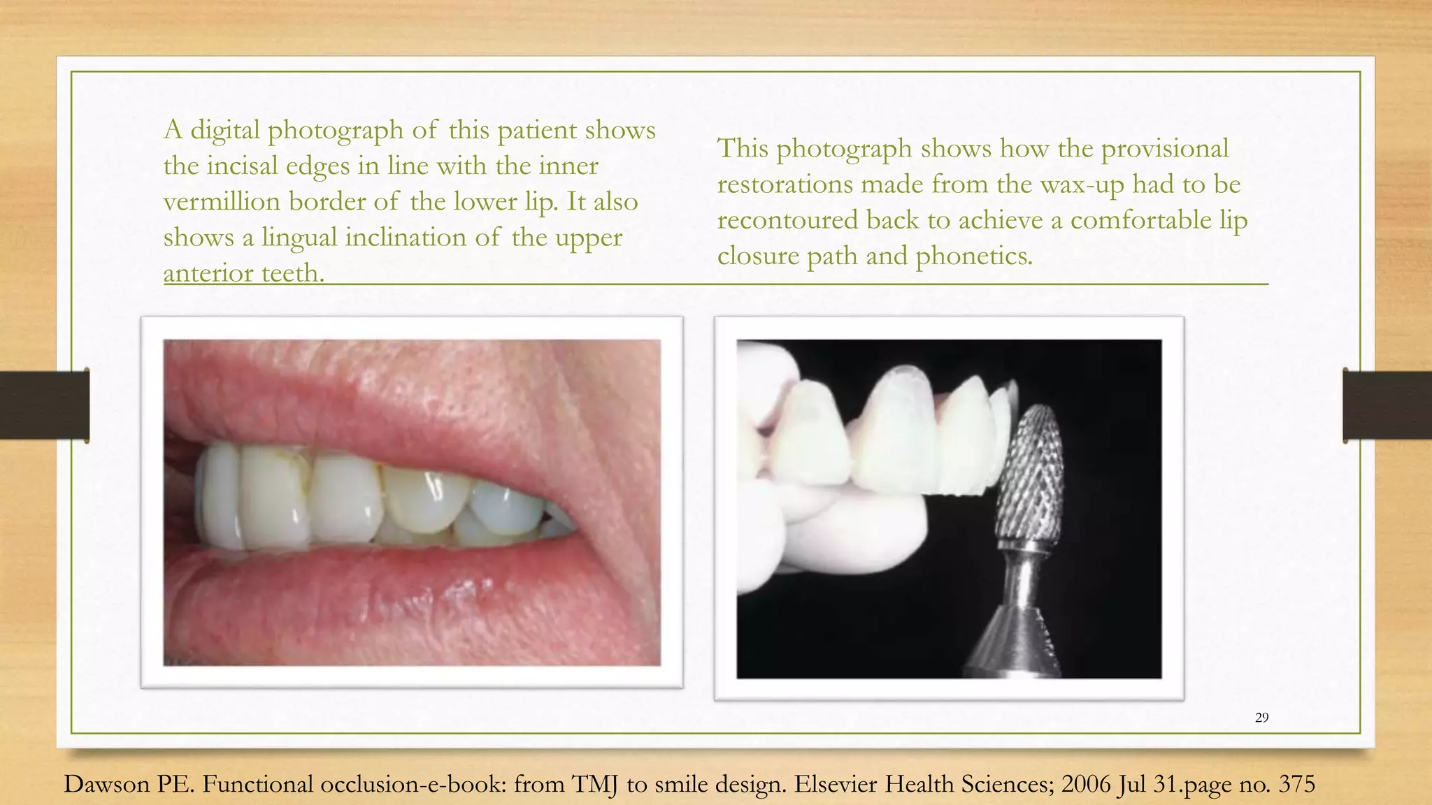 full mouth rehabilitation part 1 | PPTX