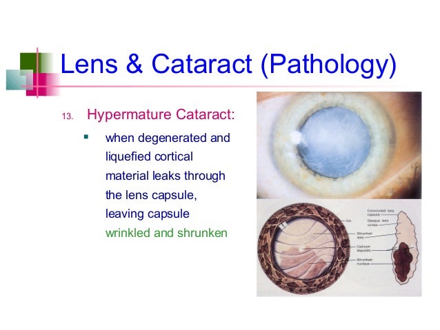 Age related Cataract
