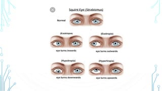 Extraocular muscles. presentation ophthal | PPTX | Eye and Vision ...
