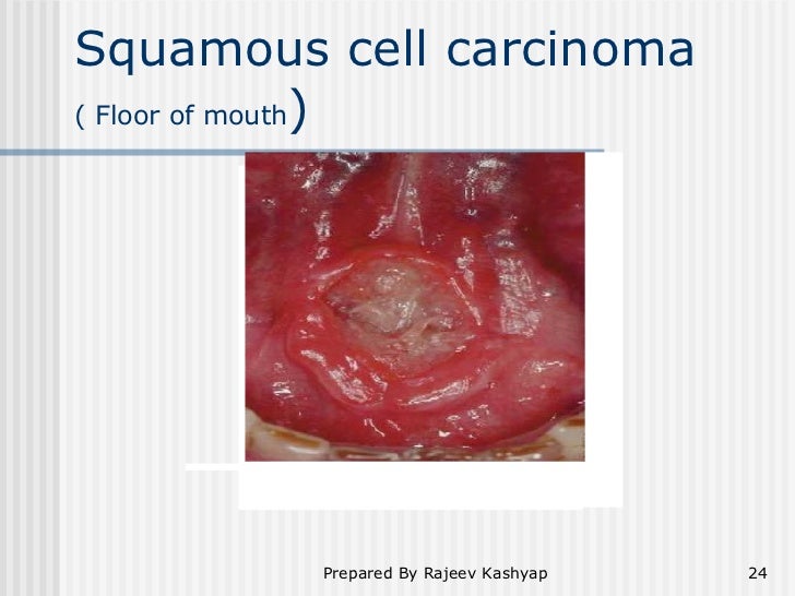 Copy Of Oral Precancer Andcancer