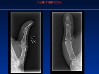 Rapid Reporting Segment 1 | PPT