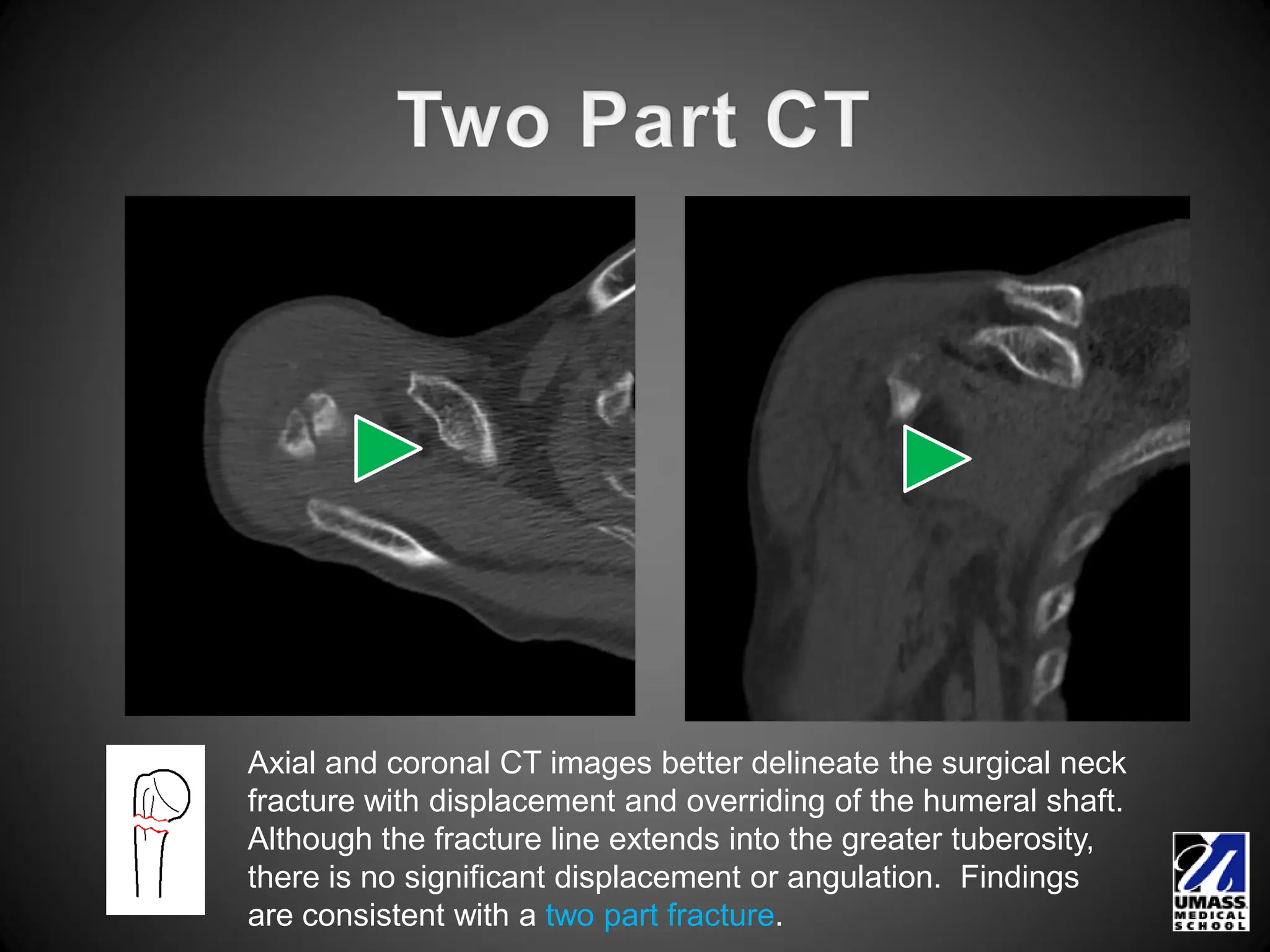 Copy-proximal-humeral-fractures---shin.pdf