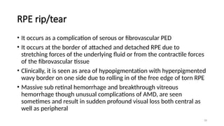 Wet Age Related Macular Degeneration and Choroidal Neovascular Membrane ...