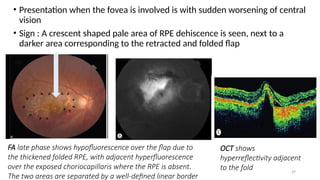 Wet Age Related Macular Degeneration and Choroidal Neovascular Membrane ...