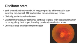 Wet Age Related Macular Degeneration and Choroidal Neovascular Membrane ...