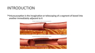 INTUSSUSCEPTION lecture for medical students.pptx
