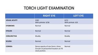 Ophthal case presentation on senile cataract | PPTX