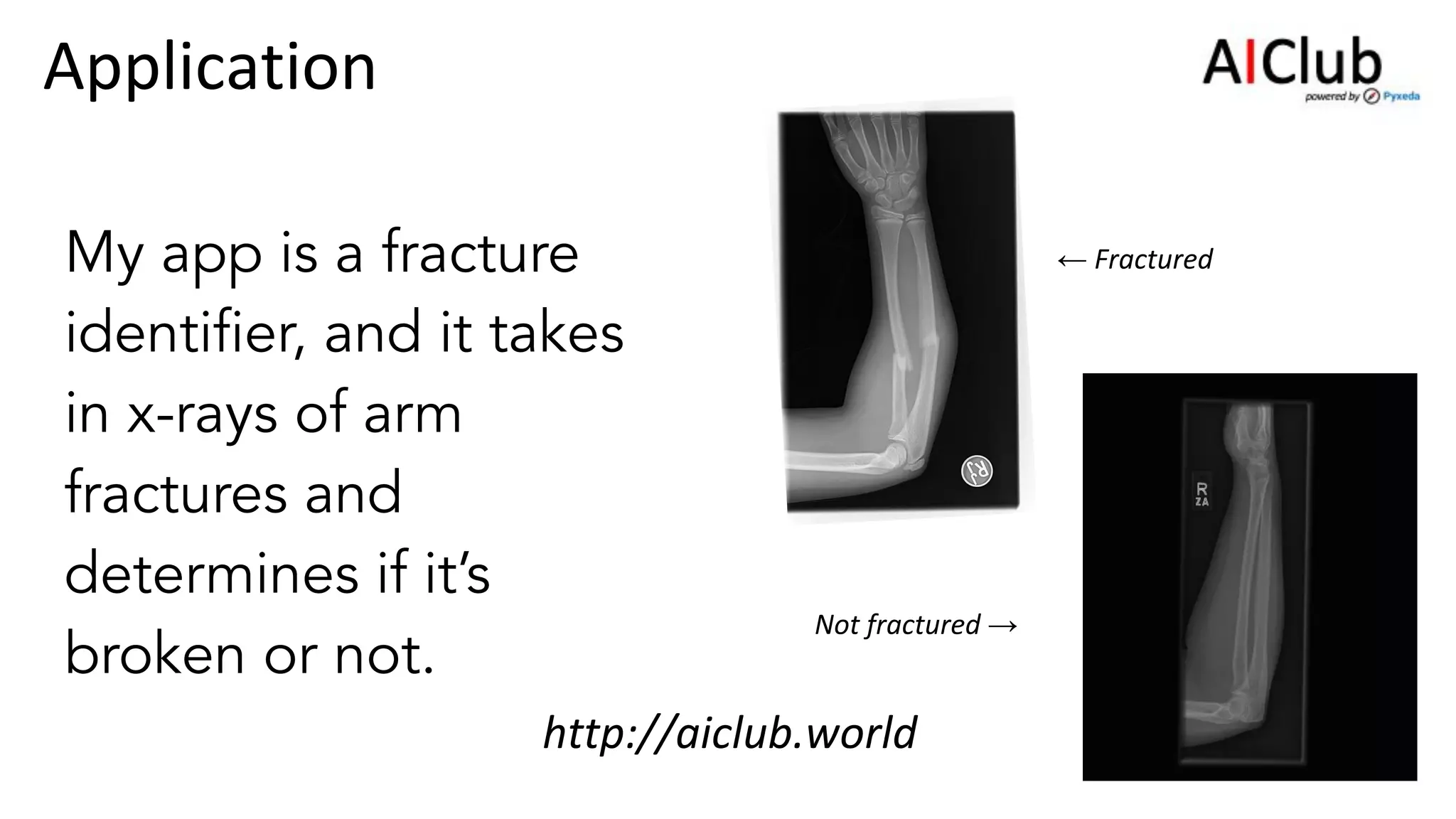 Detect Fractures With A Neural Network Aiclub Project Ppt