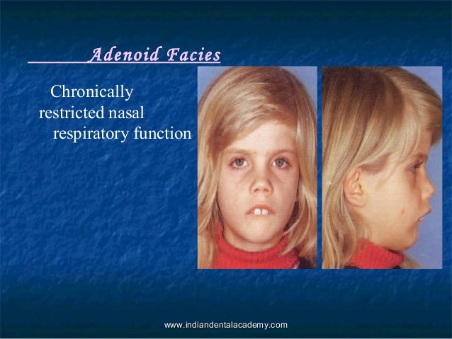 Adenoids Definition