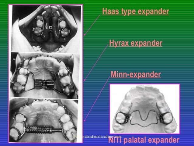 Copy of biomech of head gear /certified fixed orthodontic courses by