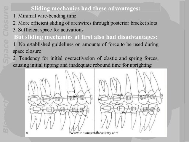 biomechanics of space closure in orthodonticcs / fixed orthodontics c…