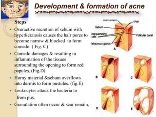 formulation and development of anti-acne cream using garlic cloves ...