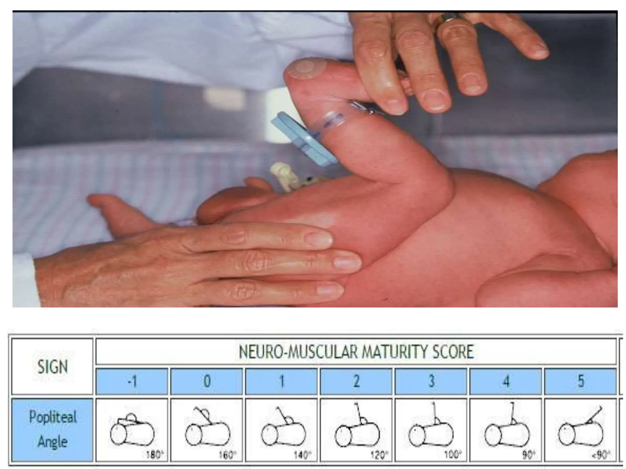 gestational age for neonates by ballard score.pptx