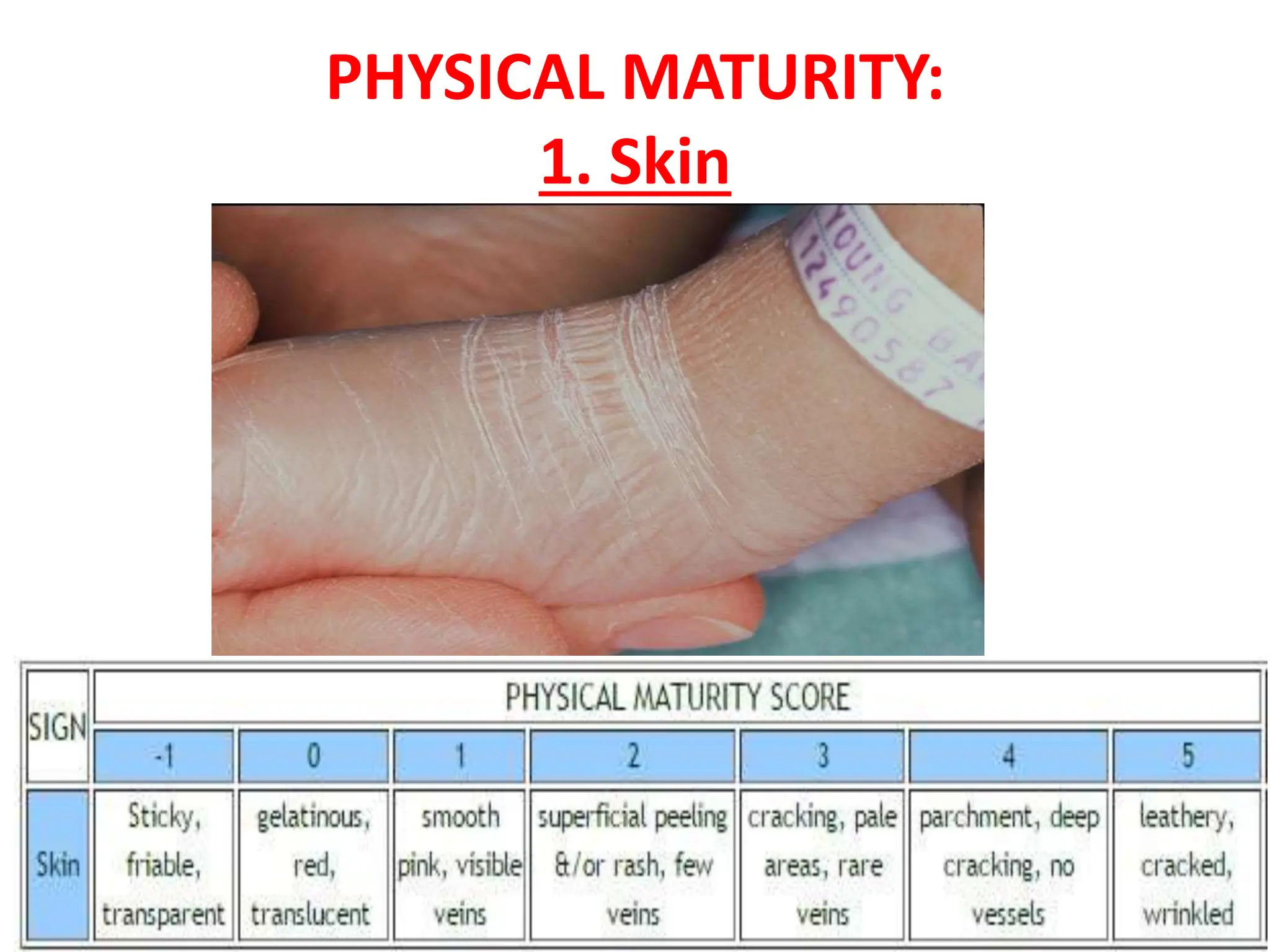 gestational age for neonates by ballard score.pptx