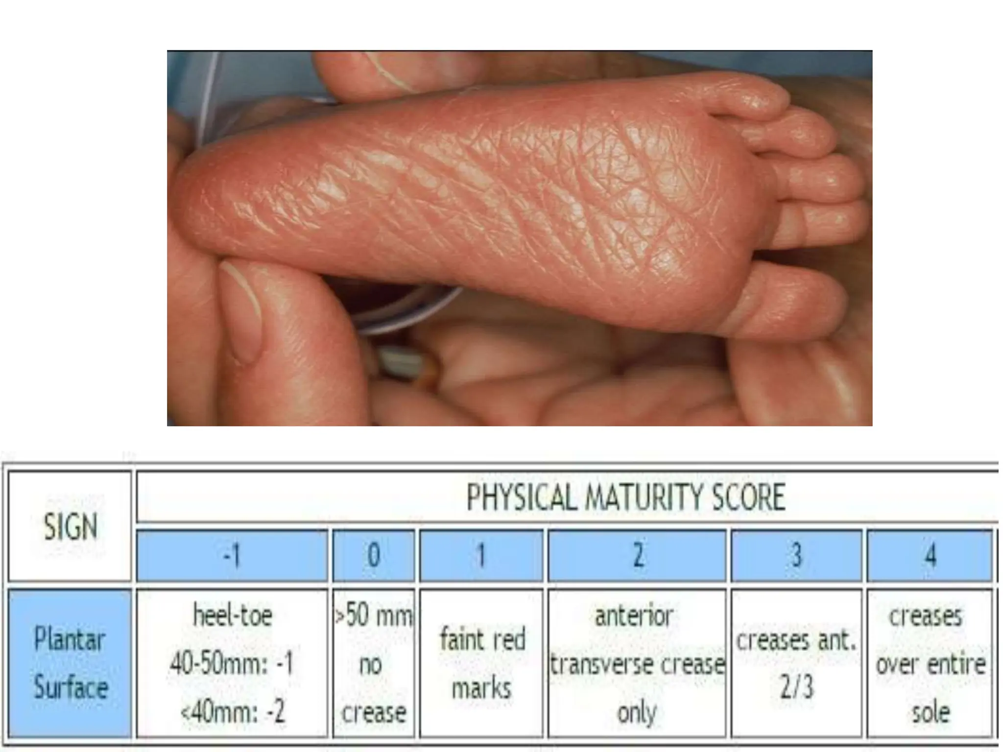 gestational age for neonates by ballard score.pptx