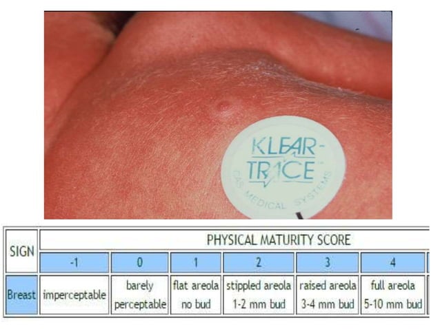 gestational age for neonates by ballard score.pptx