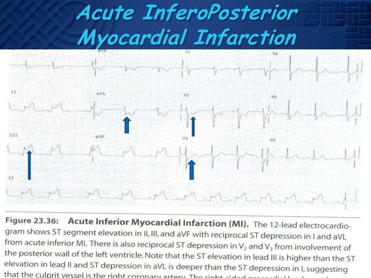 Inferior myocardial infarction