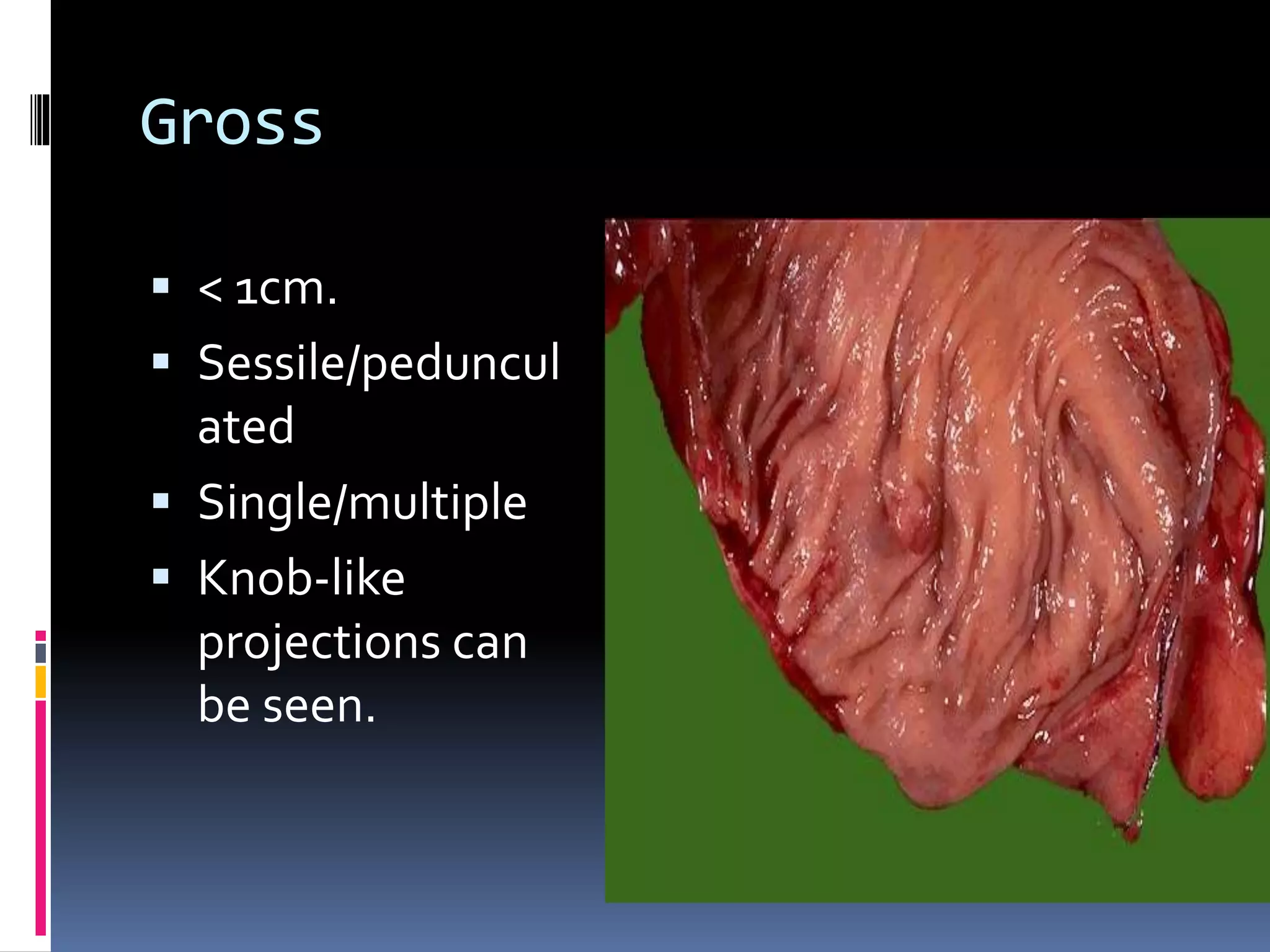 Large intestinal tumors | PPTX