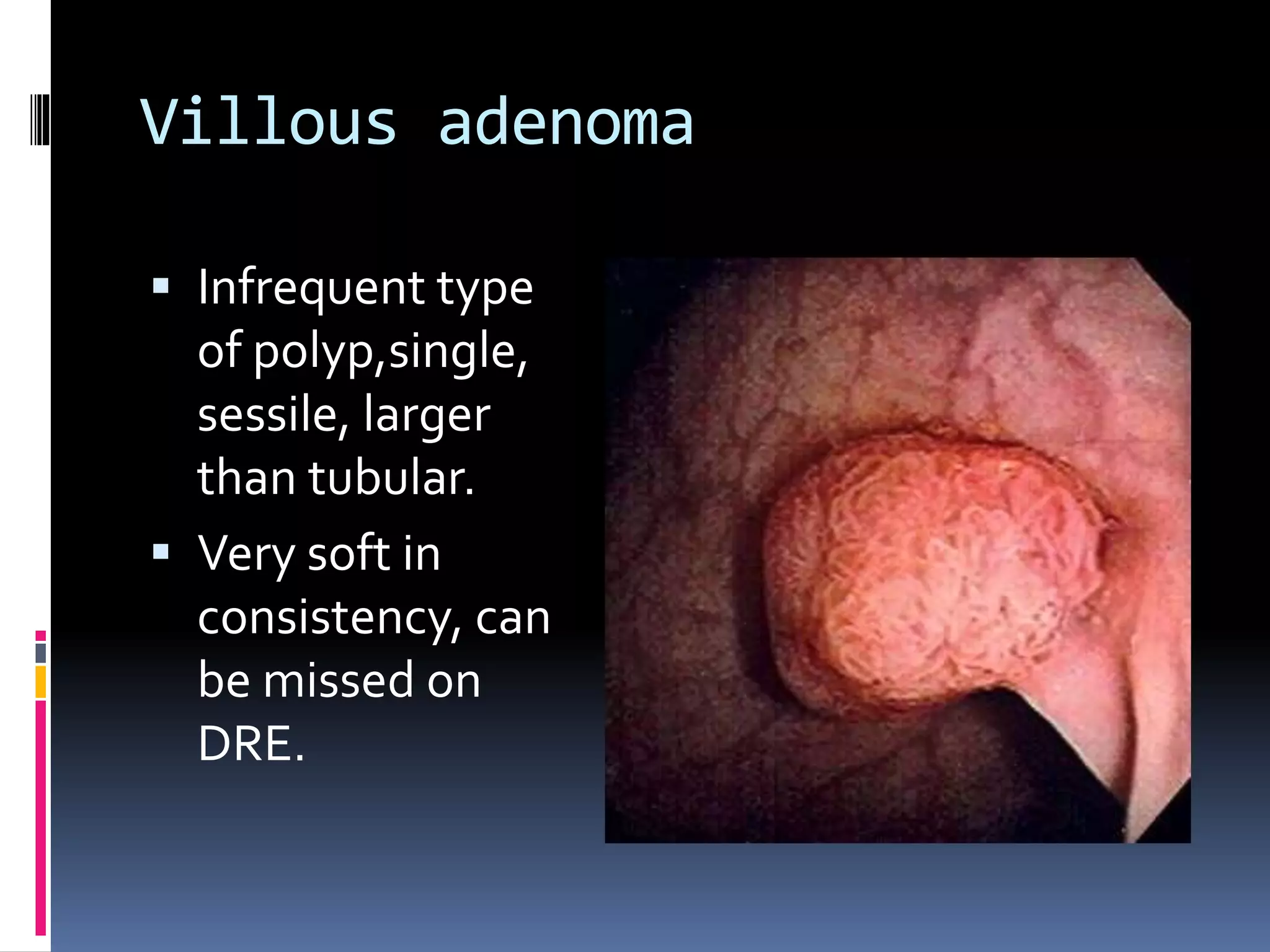Large intestinal tumors | PPTX