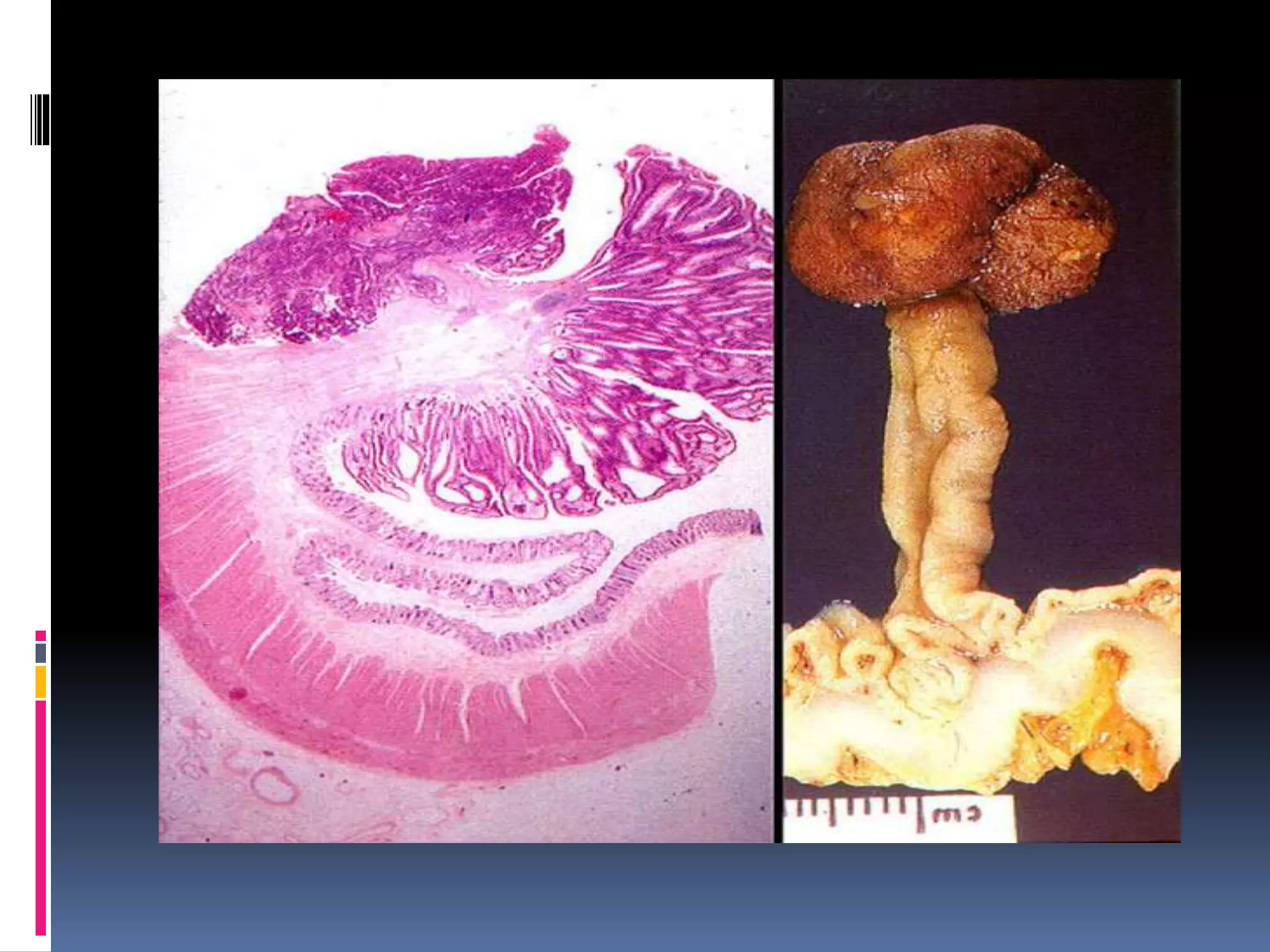 Large intestinal tumors | PPTX
