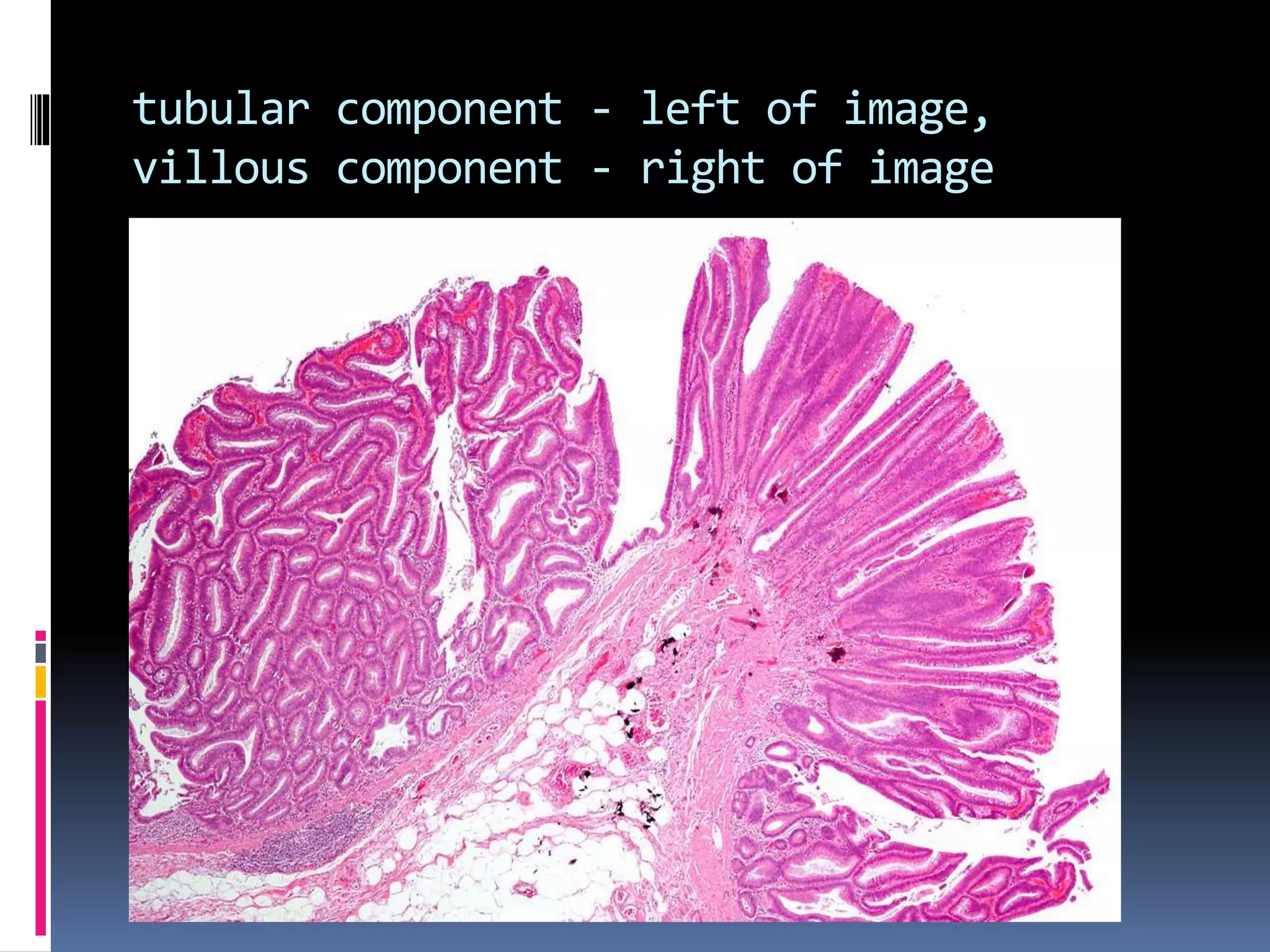 Large intestinal tumors | PPTX