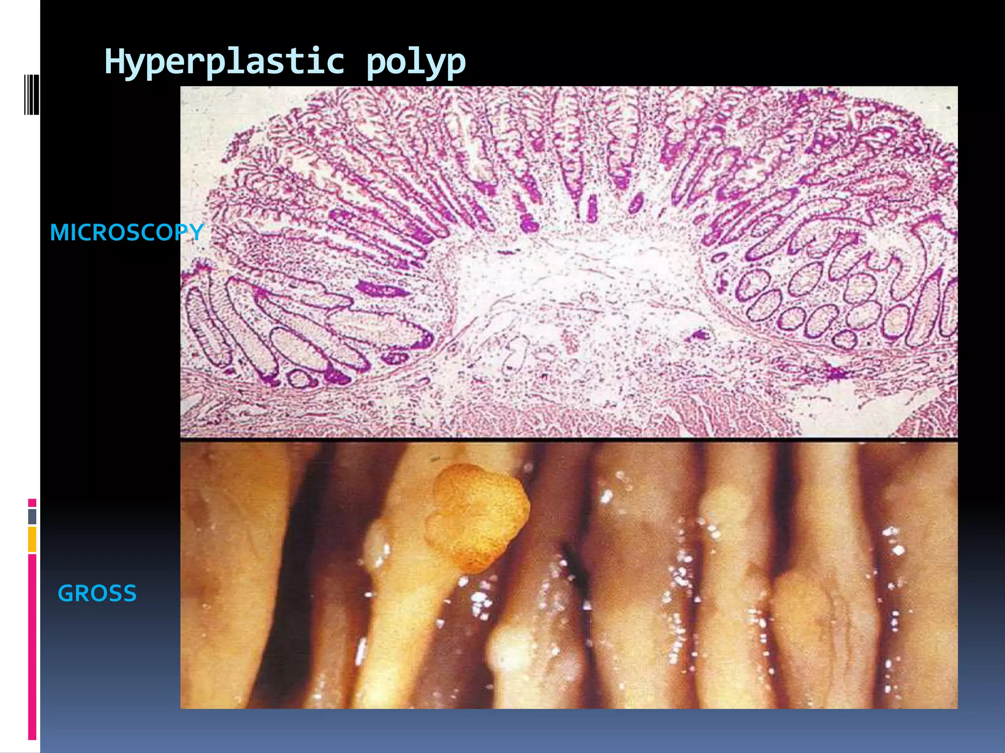 Large intestinal tumors | PPTX